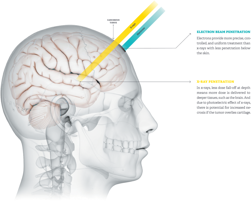 Electron Therapy for Skin Cancer and Dermatology - IntraOp