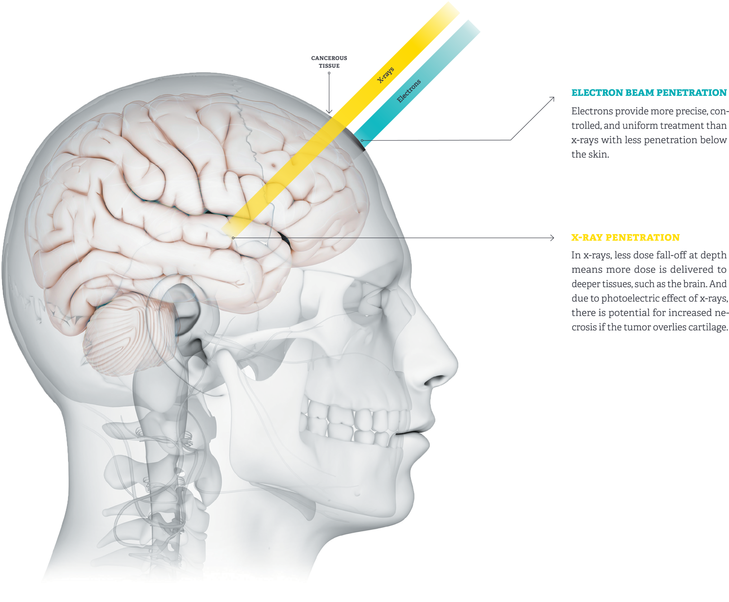 Electron Therapy for Skin Cancer and Dermatology - IntraOp